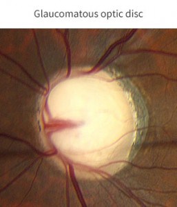 Karl W Whittaker | Consultant Eye Surgeon glaucoma-optic-disc - Karl W ...